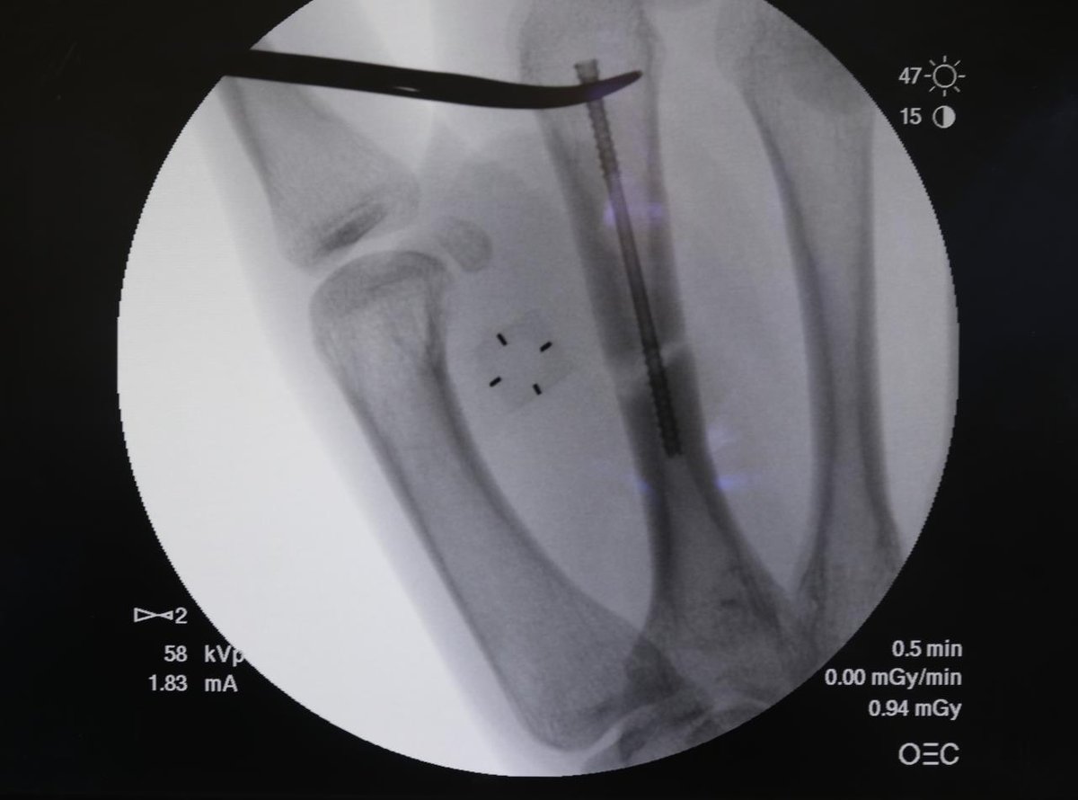 Use of NX Nail for oblique fracture fixation of 2nd metacarpal